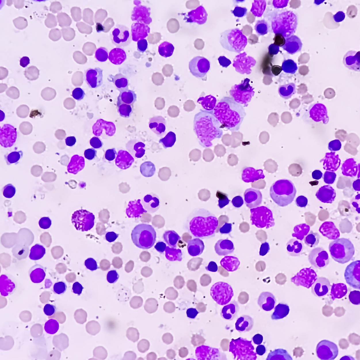 HMA Therapy Associated with Favorable Long-Term Clinical Outcomes in ...